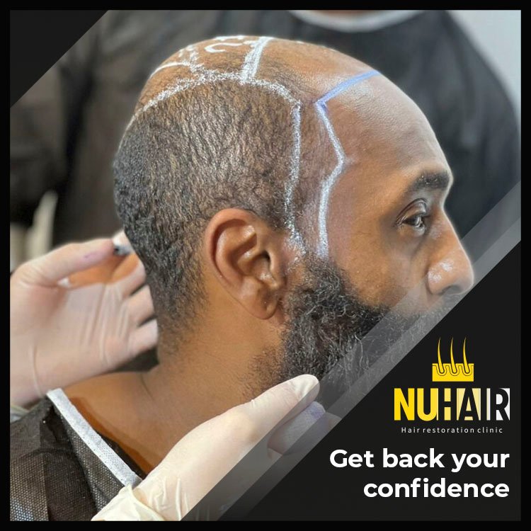 Afro Hair Transplant - Nu Hair Vip