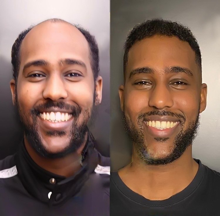 Afro Hair Transplant - Nu Hair Vip