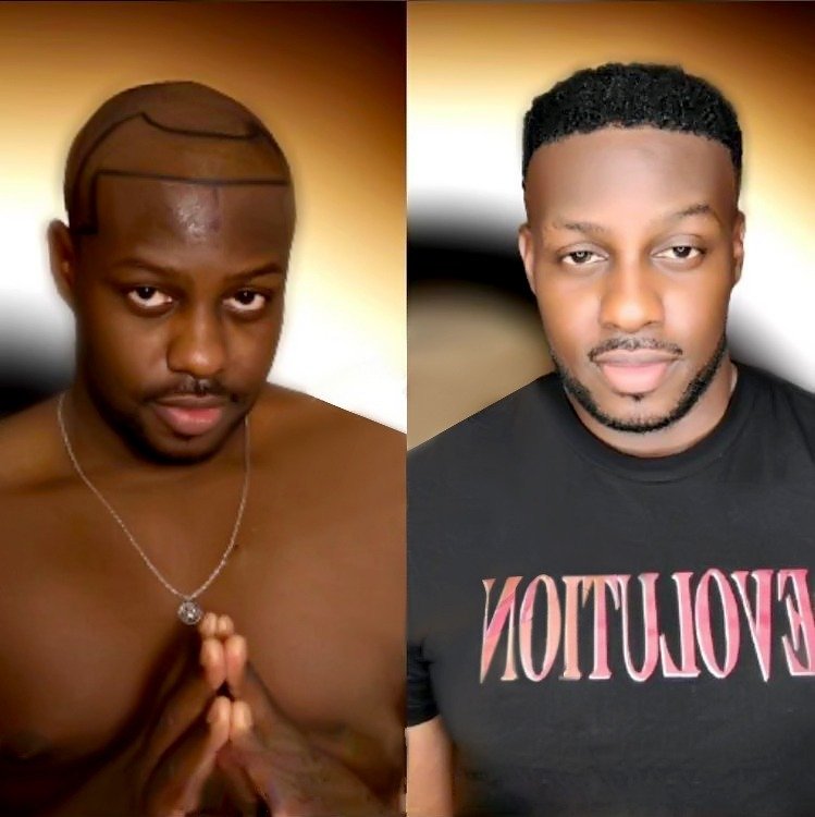 Afro Hair Transplant - Nu Hair Vip