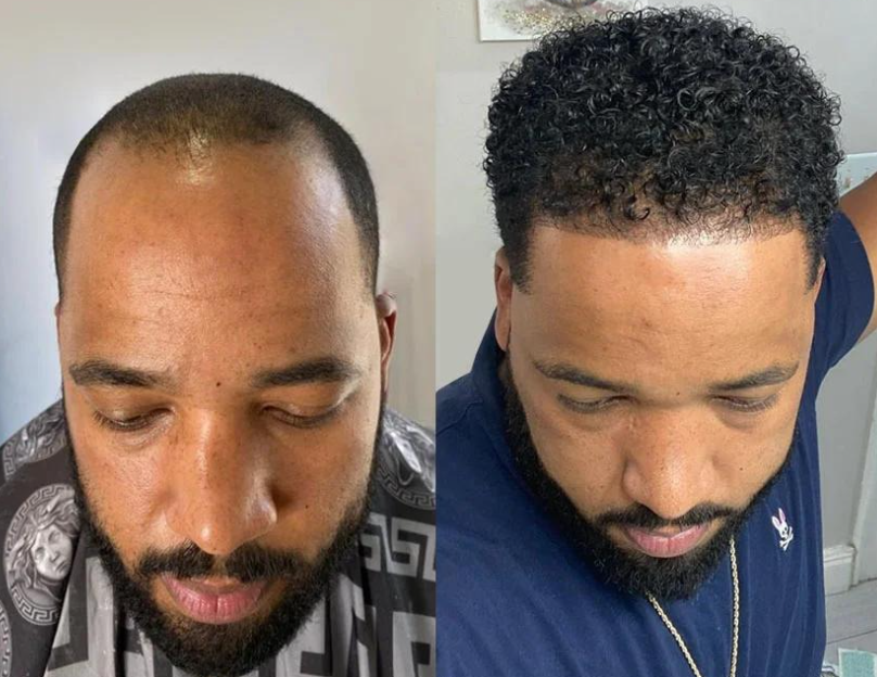Fue Follicular Unit Extraction Old Hair Transplant Turkey